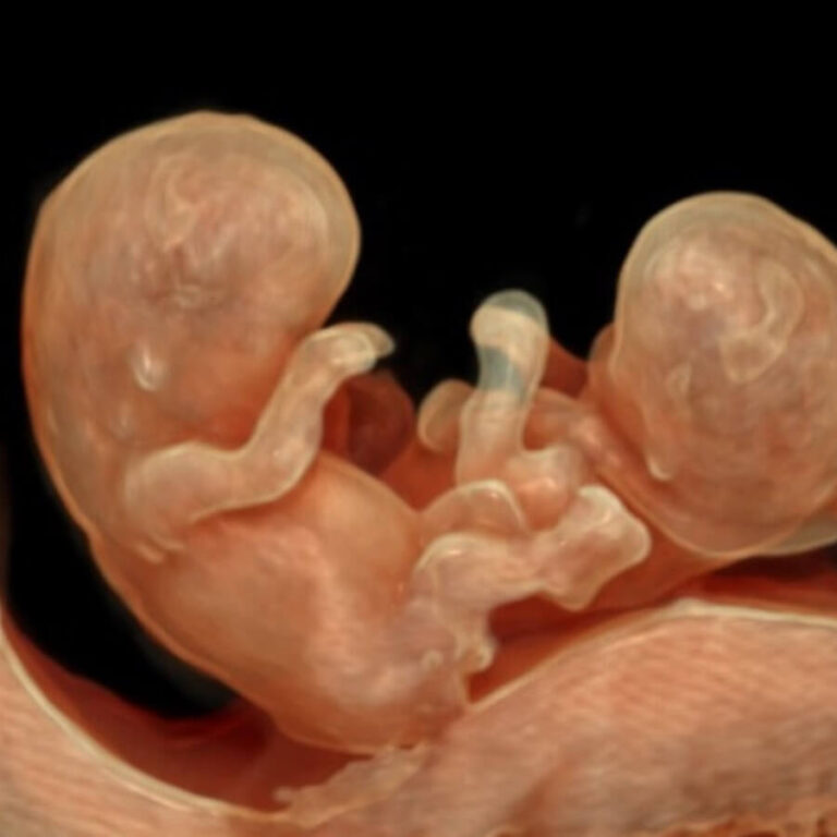 Ecografía de Embarazo Múltiple – Medicina Fetal Perú